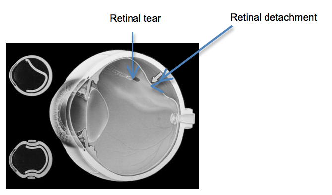 Retinal detachment